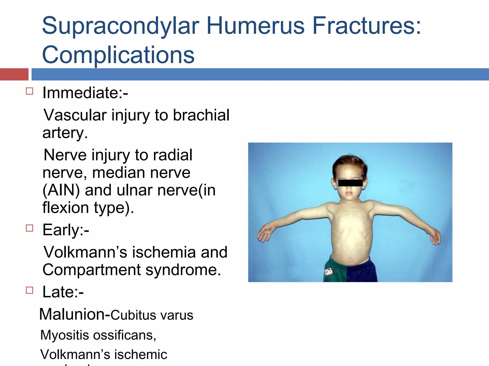 Fracture of Distal End Humerus. | PPT