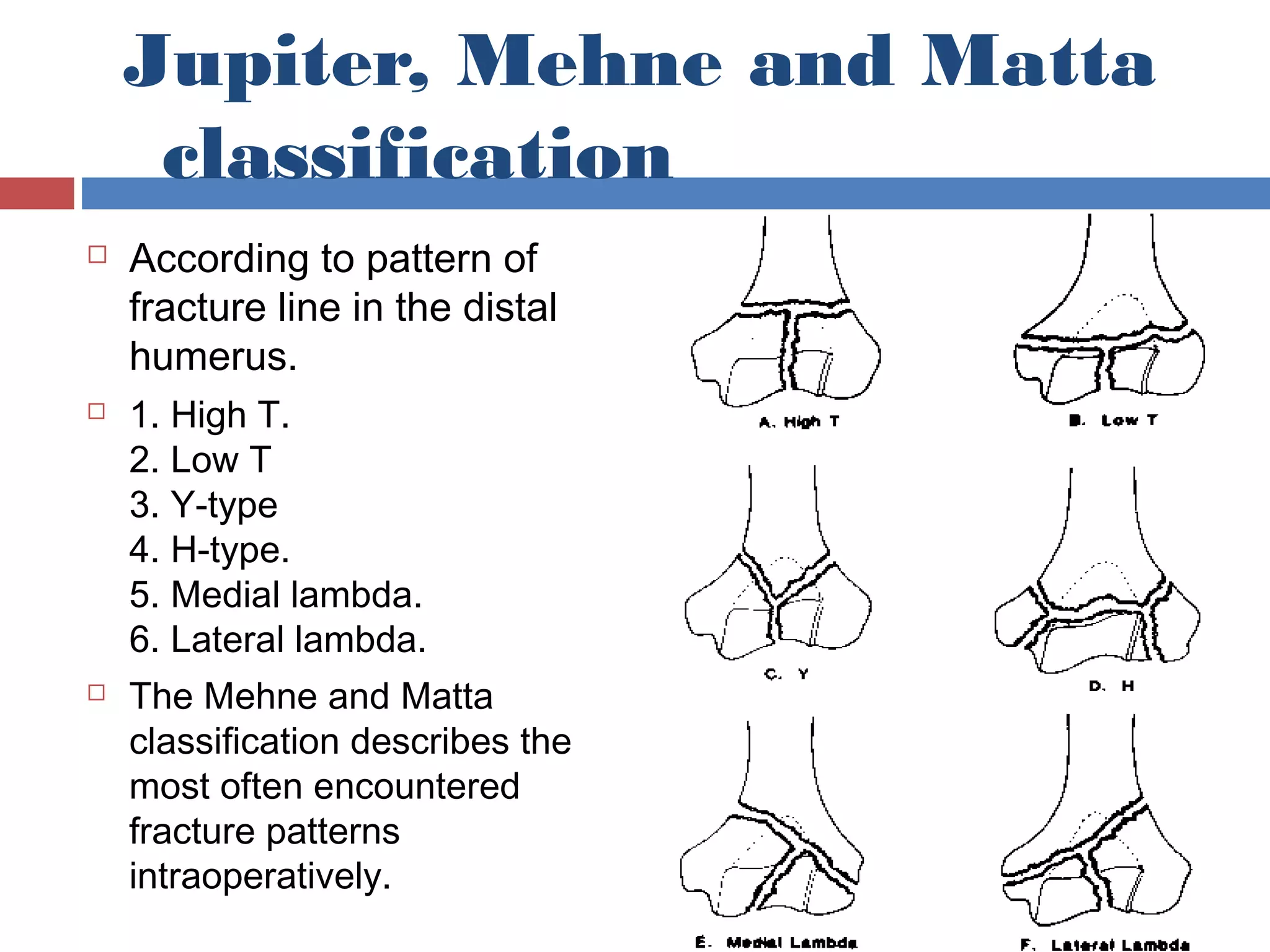 Fracture of Distal End Humerus. | PPT