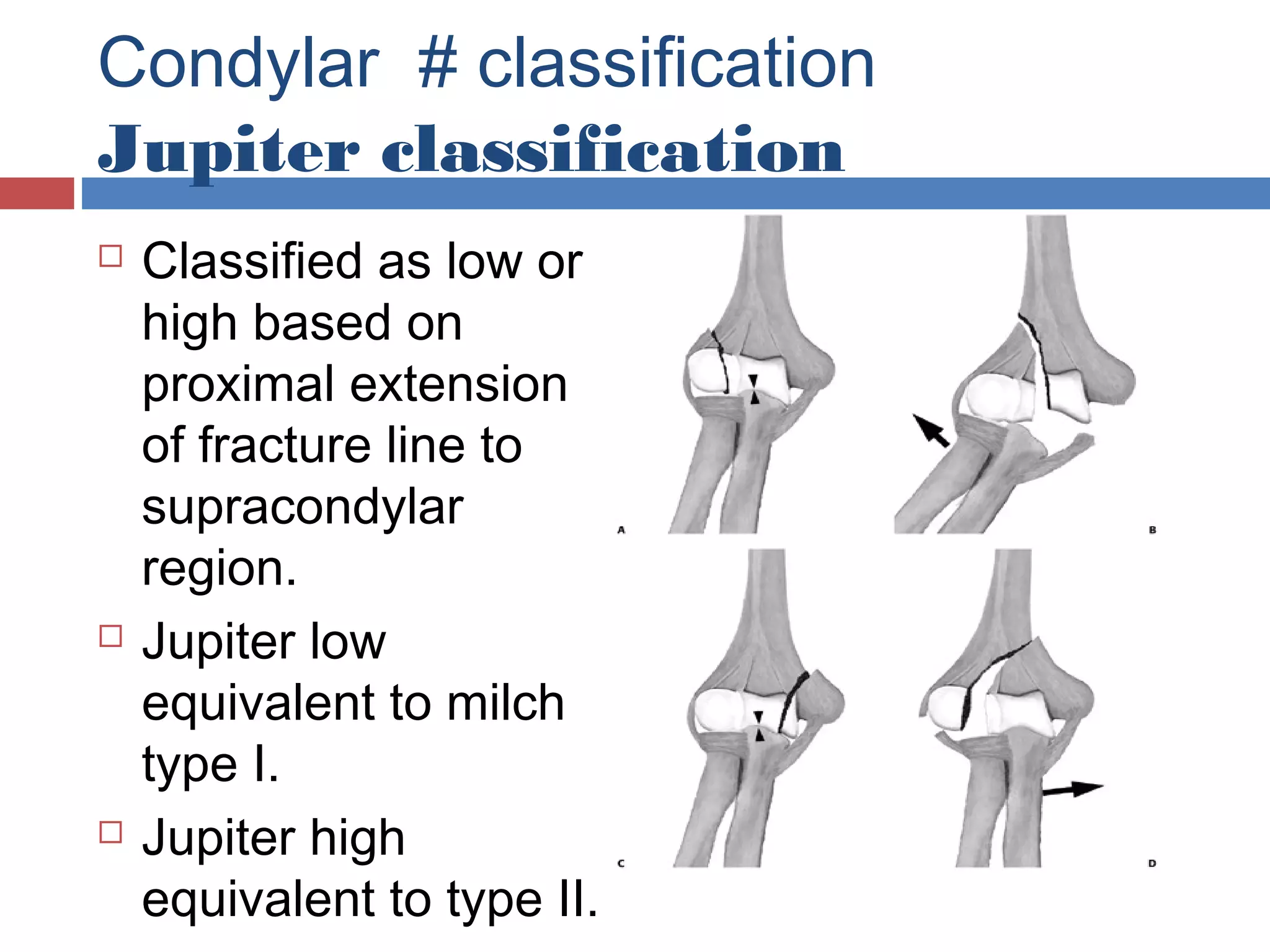 Fracture of Distal End Humerus. | PPT