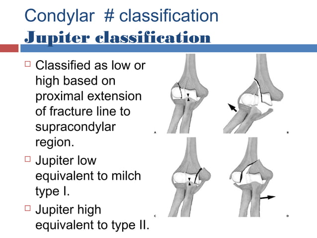 Fracture of Distal End Humerus. | PPT | Death, Injury, or Military ...