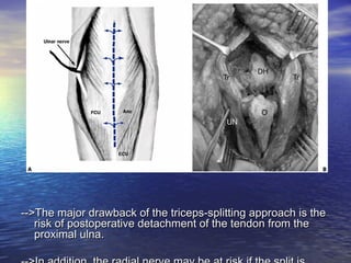 Fracture of Distal End Humerus. | PPT