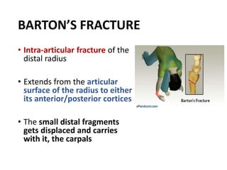 Fracture of distal radius | PPTX