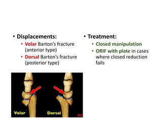 Barton Fracture
