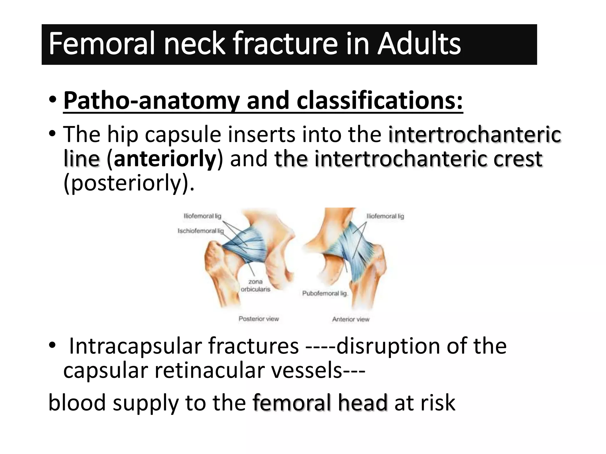 Fracture Of Femoral Neck In Adults.pptx
