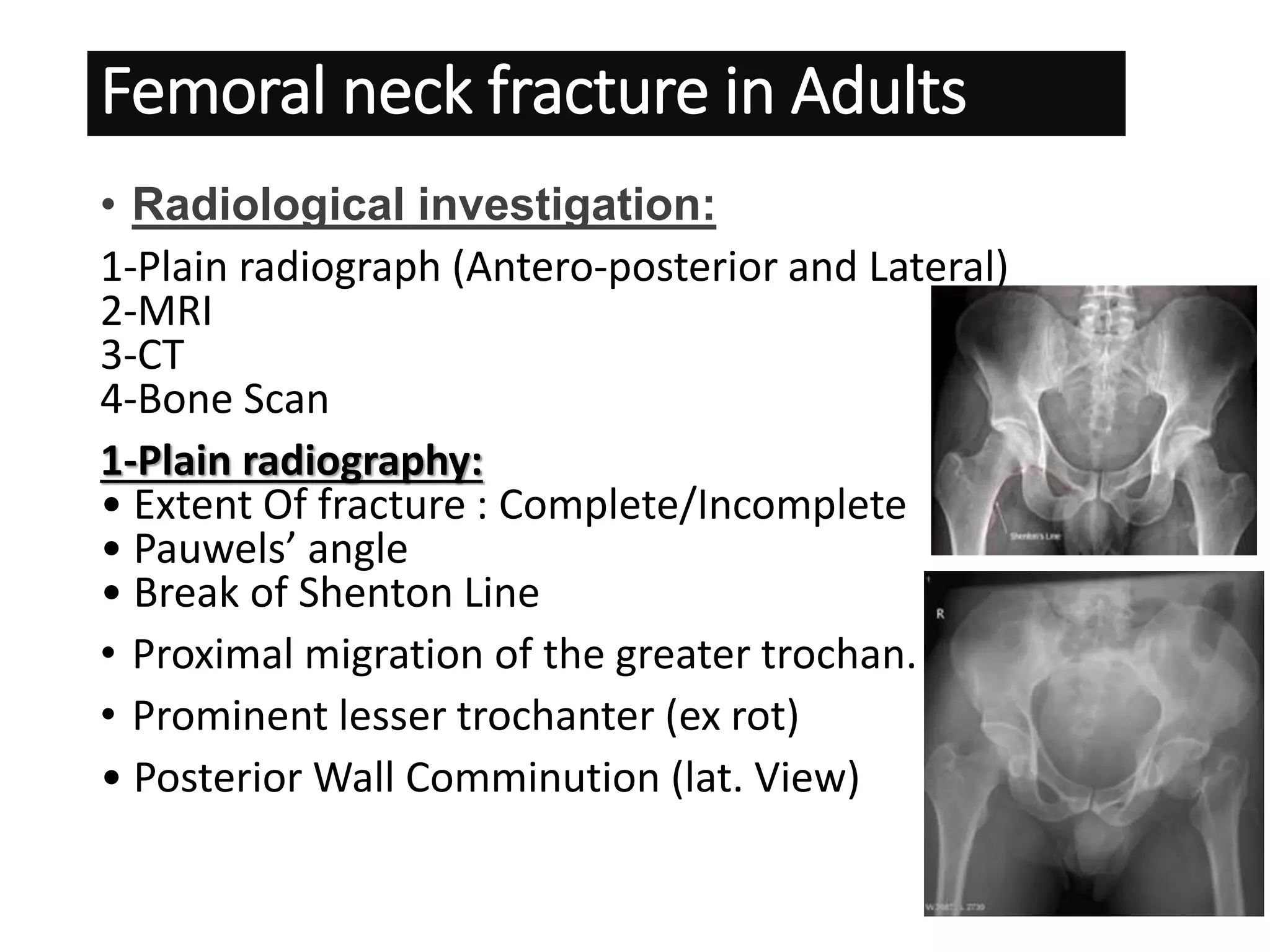 Fracture Of Femoral Neck In Adults.pptx