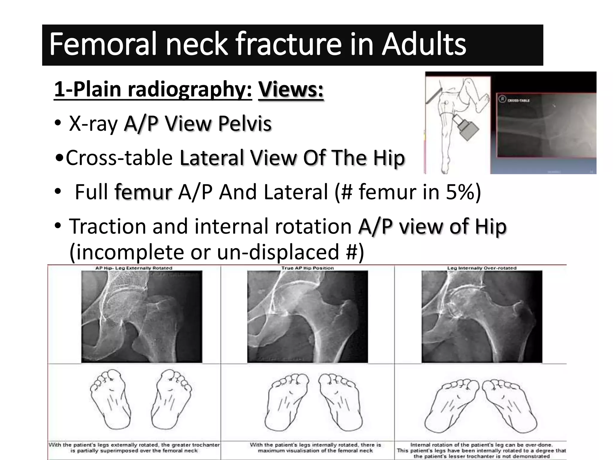 Fracture Of Femoral Neck In Adults.pptx