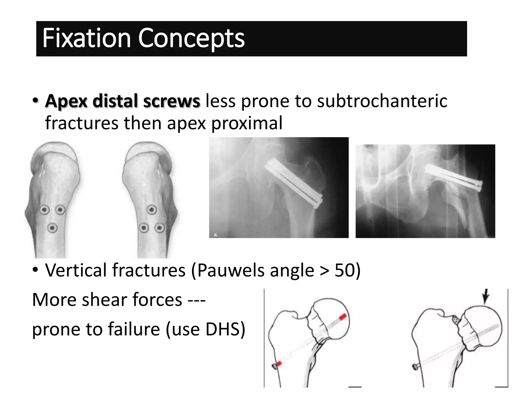 Fracture Of Femoral Neck In Adults.pptx