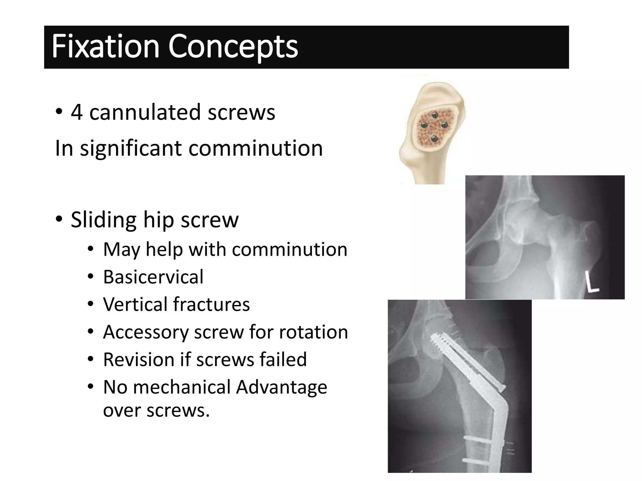 Fracture Of Femoral Neck In Adults.pptx