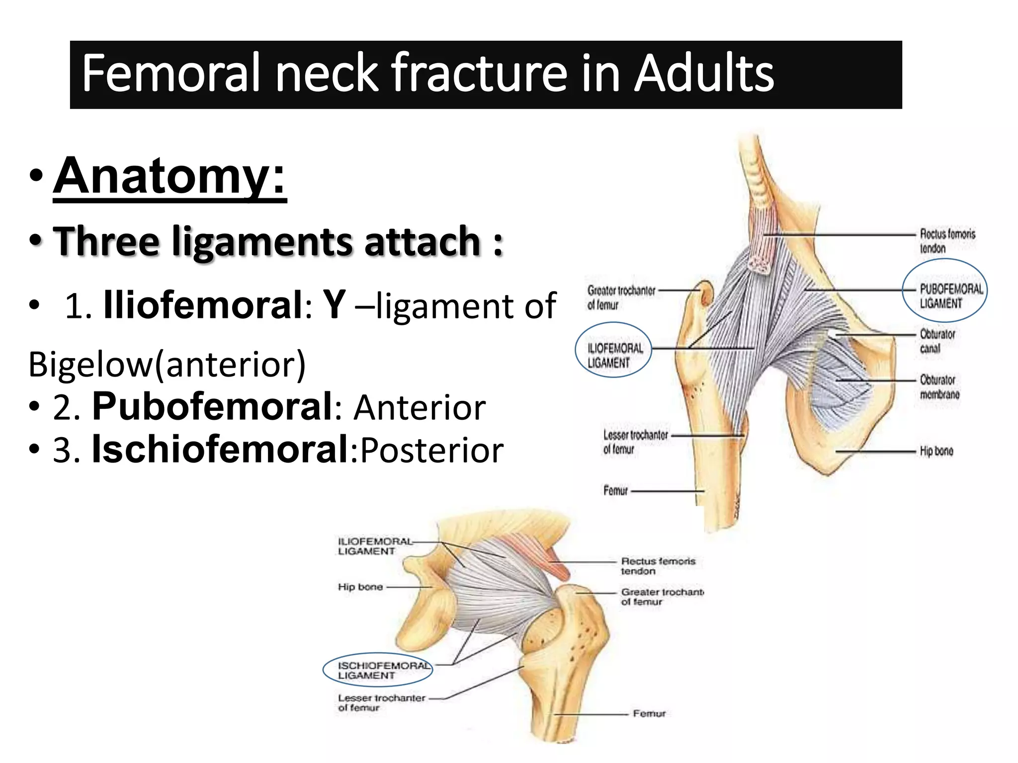 Fracture Of Femoral Neck In Adults.pptx