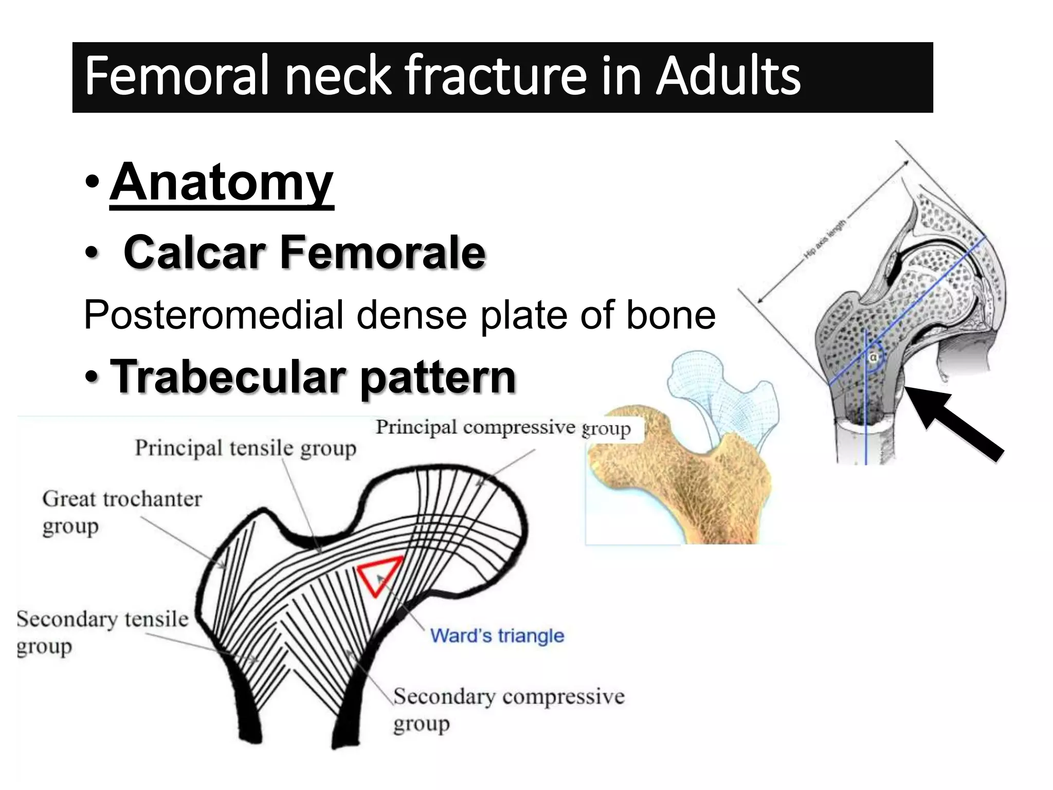 Fracture Of Femoral Neck In Adults.pptx