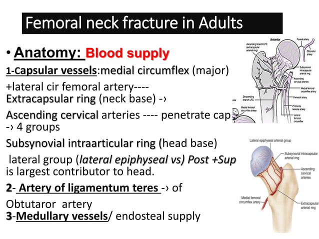 Fracture Of Femoral Neck In Adults.pptx | Death, Injury, or Military ...