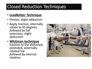Fracture Of Femoral Neck In Adults.pptx