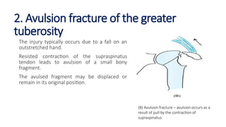 Fracture of greater tuberosity & physiotherapy management | PPTX