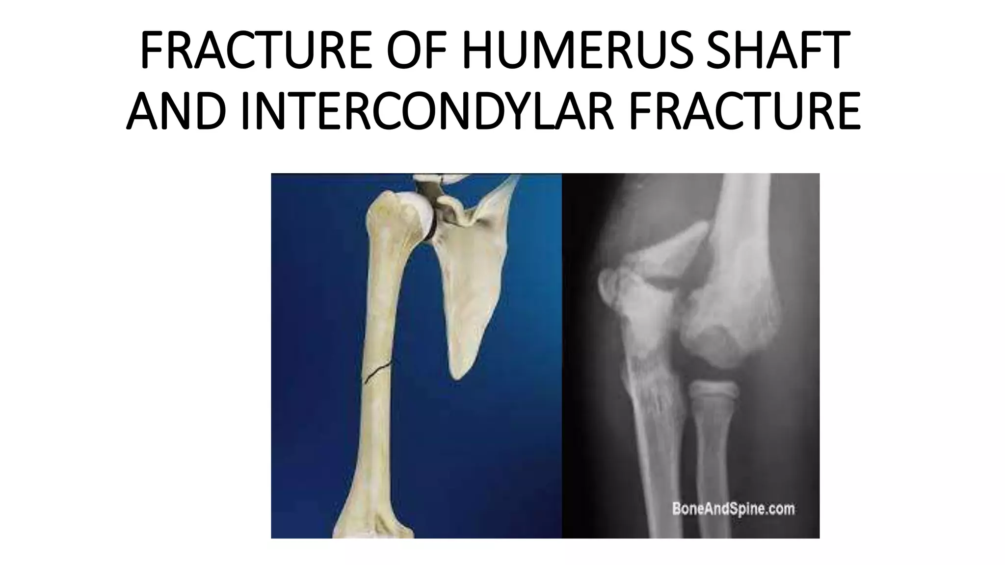 FRACTURE OF HUMERUS SHAFT AND INTERCONDYLAR FRACTURE.pdf