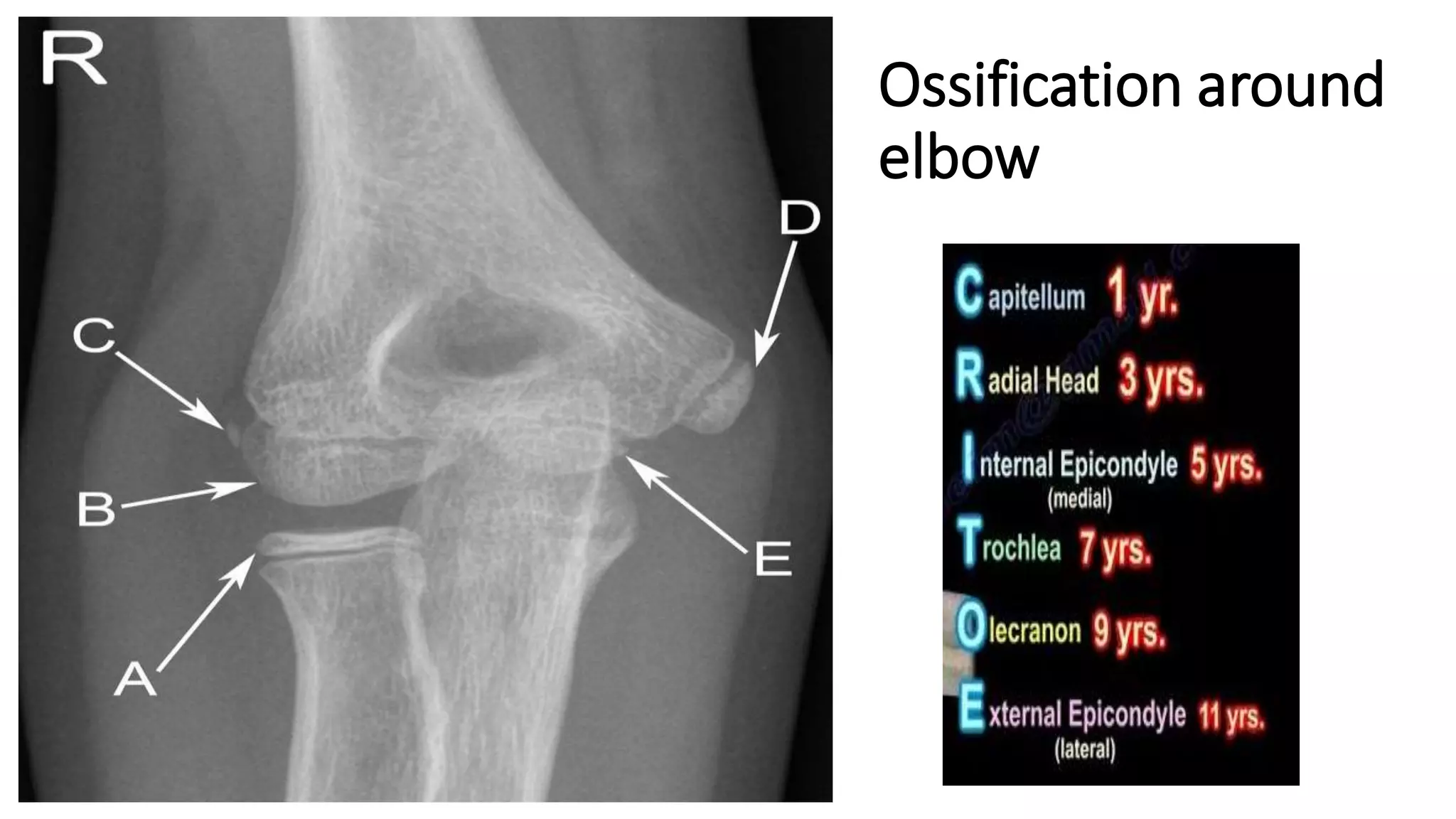 FRACTURE OF HUMERUS SHAFT AND INTERCONDYLAR FRACTURE.pdf