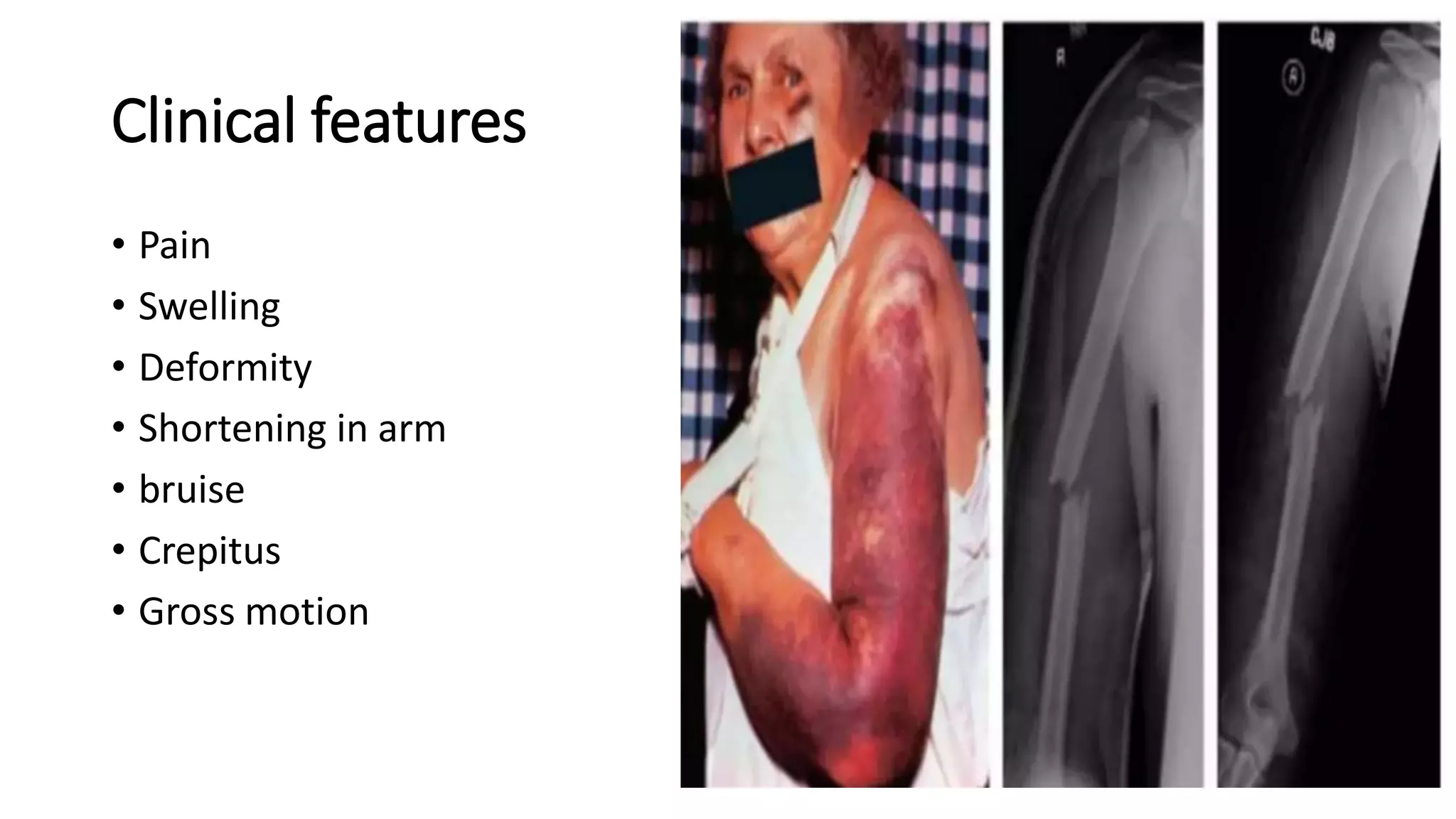 FRACTURE OF HUMERUS SHAFT AND INTERCONDYLAR FRACTURE.pdf