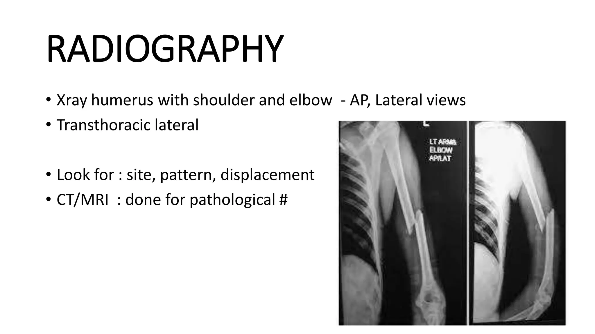 FRACTURE OF HUMERUS SHAFT AND INTERCONDYLAR FRACTURE.pdf