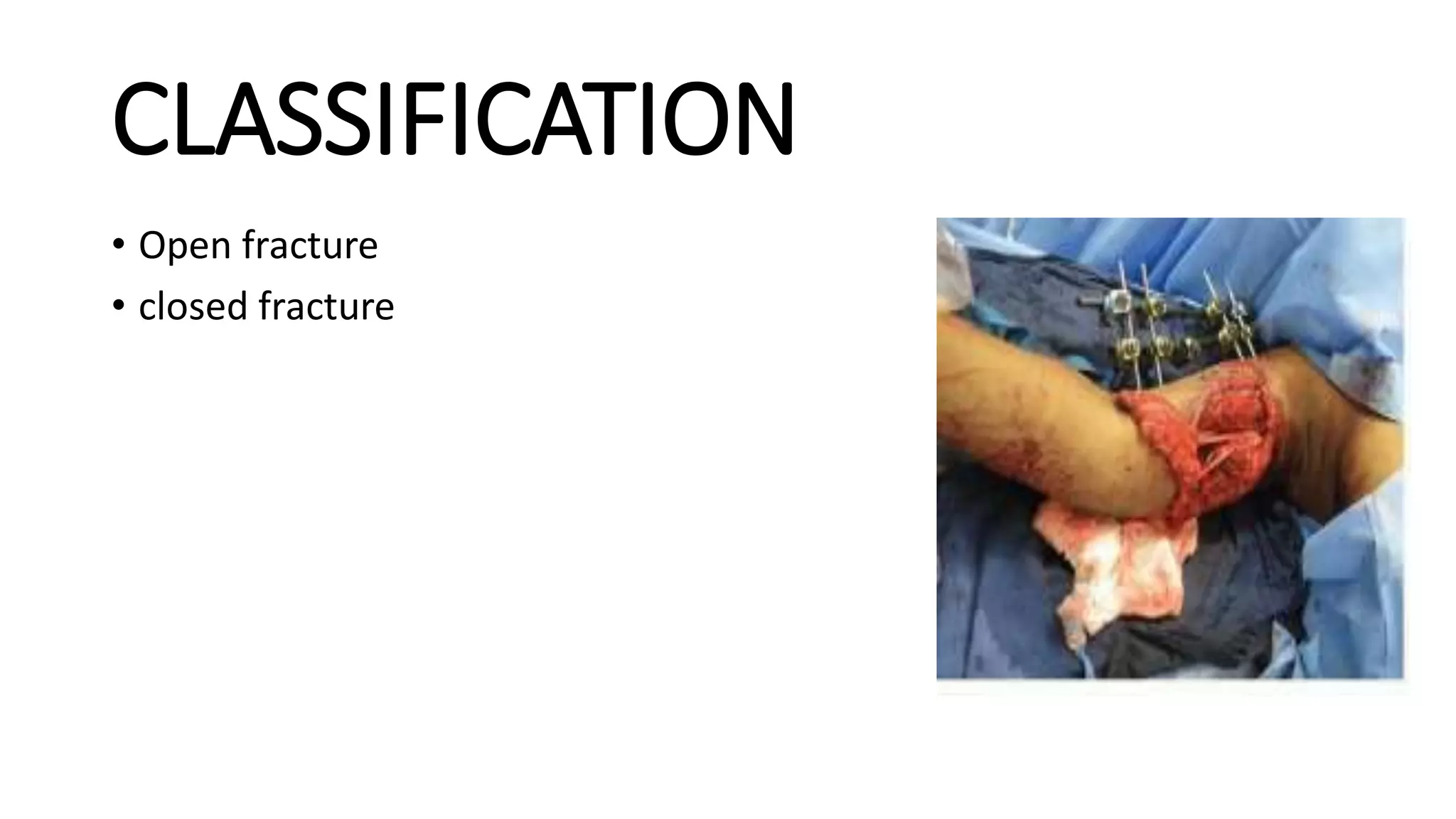 FRACTURE OF HUMERUS SHAFT AND INTERCONDYLAR FRACTURE.pdf