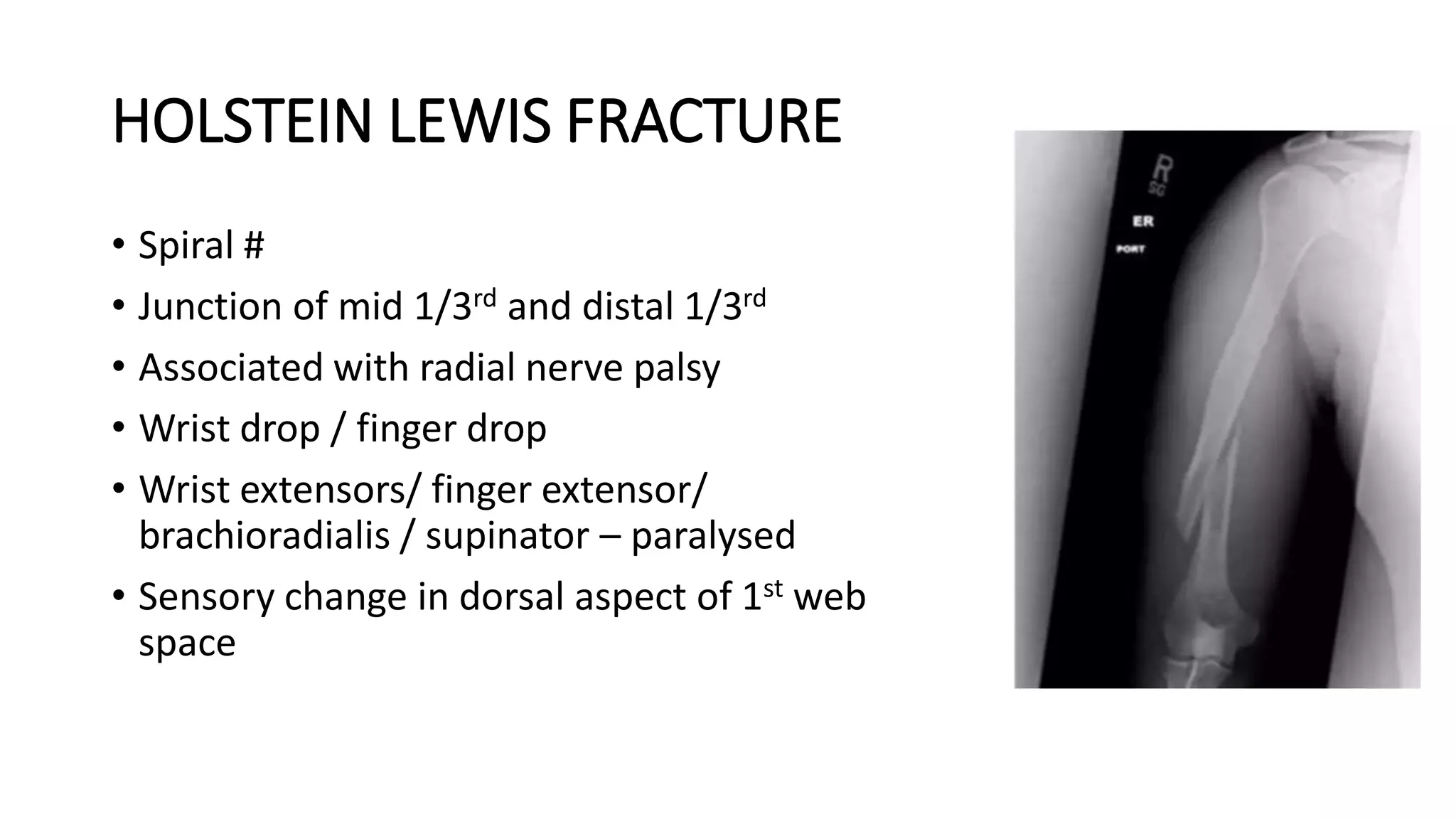 FRACTURE OF HUMERUS SHAFT AND INTERCONDYLAR FRACTURE.pdf