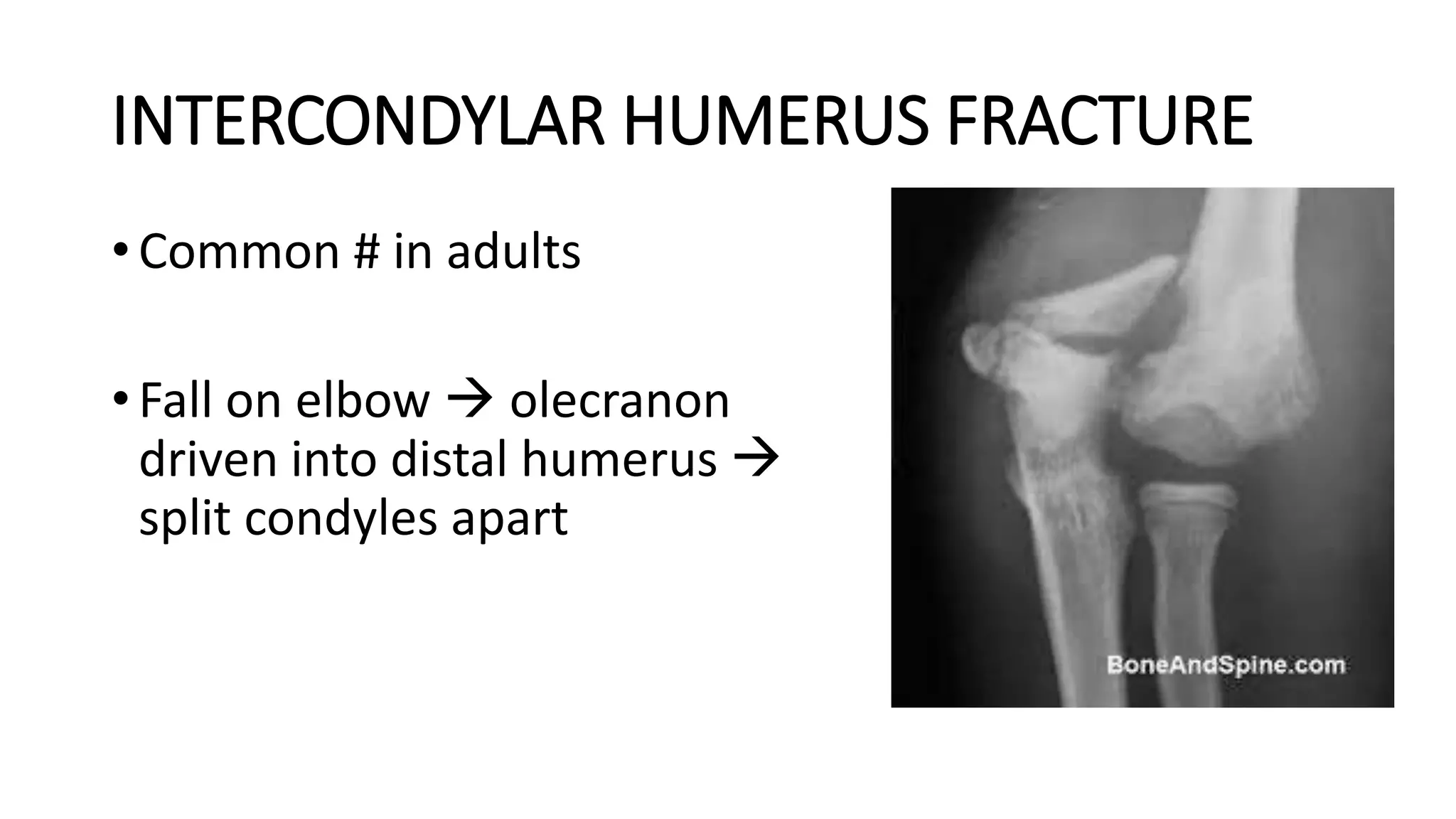 FRACTURE OF HUMERUS SHAFT AND INTERCONDYLAR FRACTURE.pdf