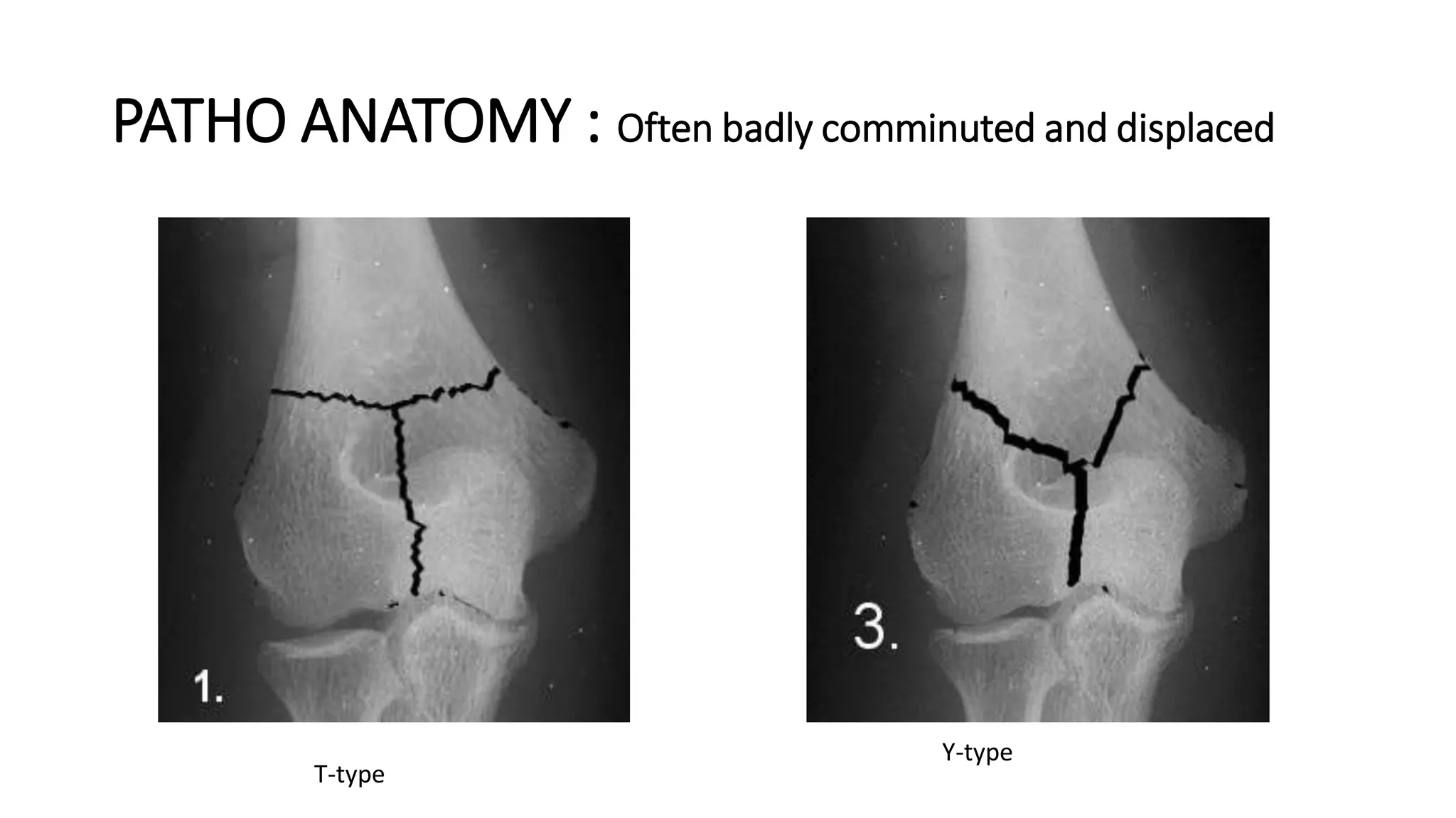 FRACTURE OF HUMERUS SHAFT AND INTERCONDYLAR FRACTURE.pdf