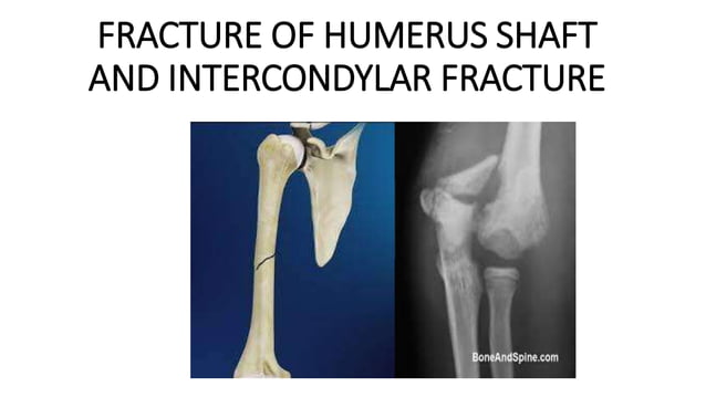 FRACTURE OF HUMERUS SHAFT AND INTERCONDYLAR FRACTURE.pdf