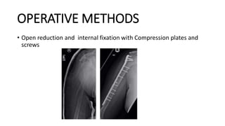 FRACTURE OF HUMERUS SHAFT AND INTERCONDYLAR FRACTURE.pdf