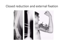 FRACTURE OF HUMERUS SHAFT AND INTERCONDYLAR FRACTURE.pdf