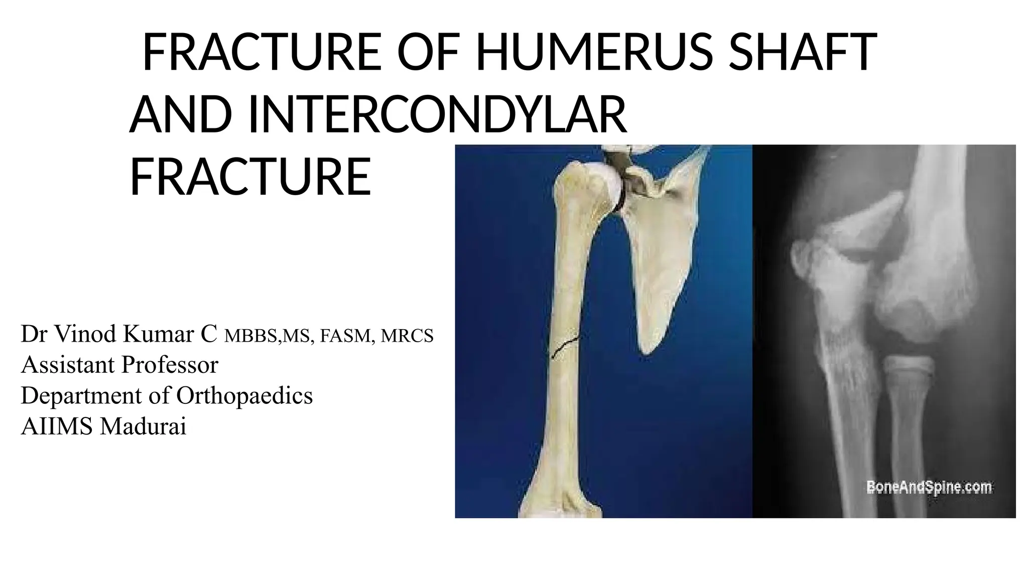 fracture of humerus shaft and intercondylar fracture.pptx