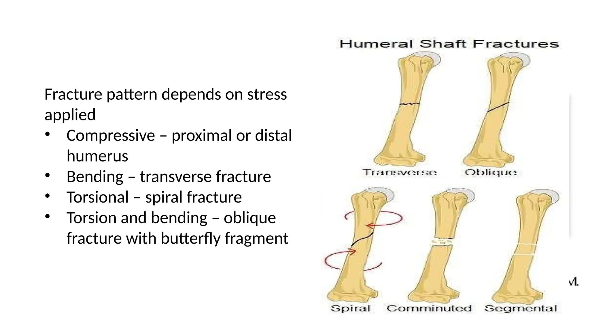 fracture of humerus shaft and intercondylar fracture.pptx