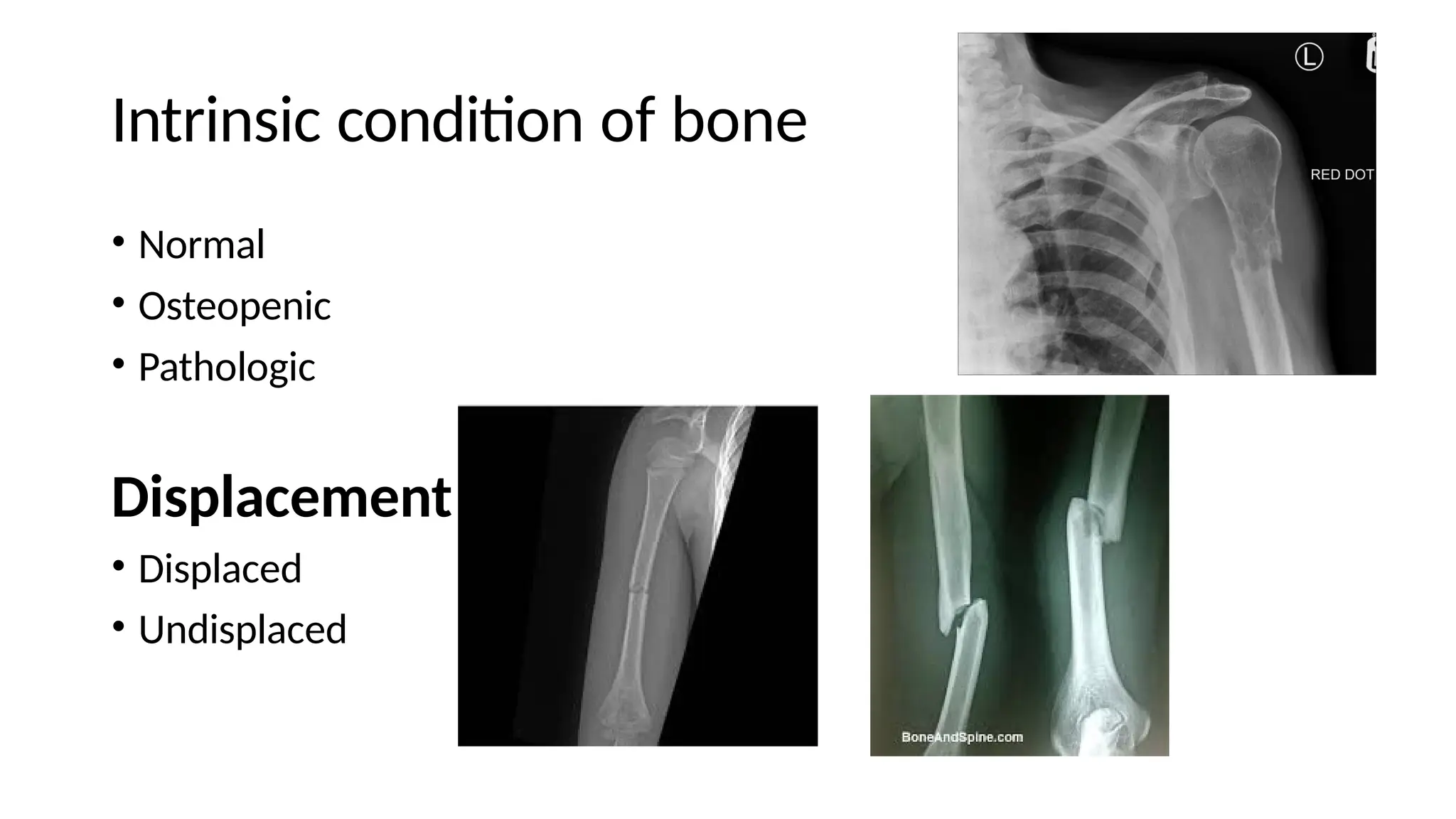 fracture of humerus shaft and intercondylar fracture.pptx