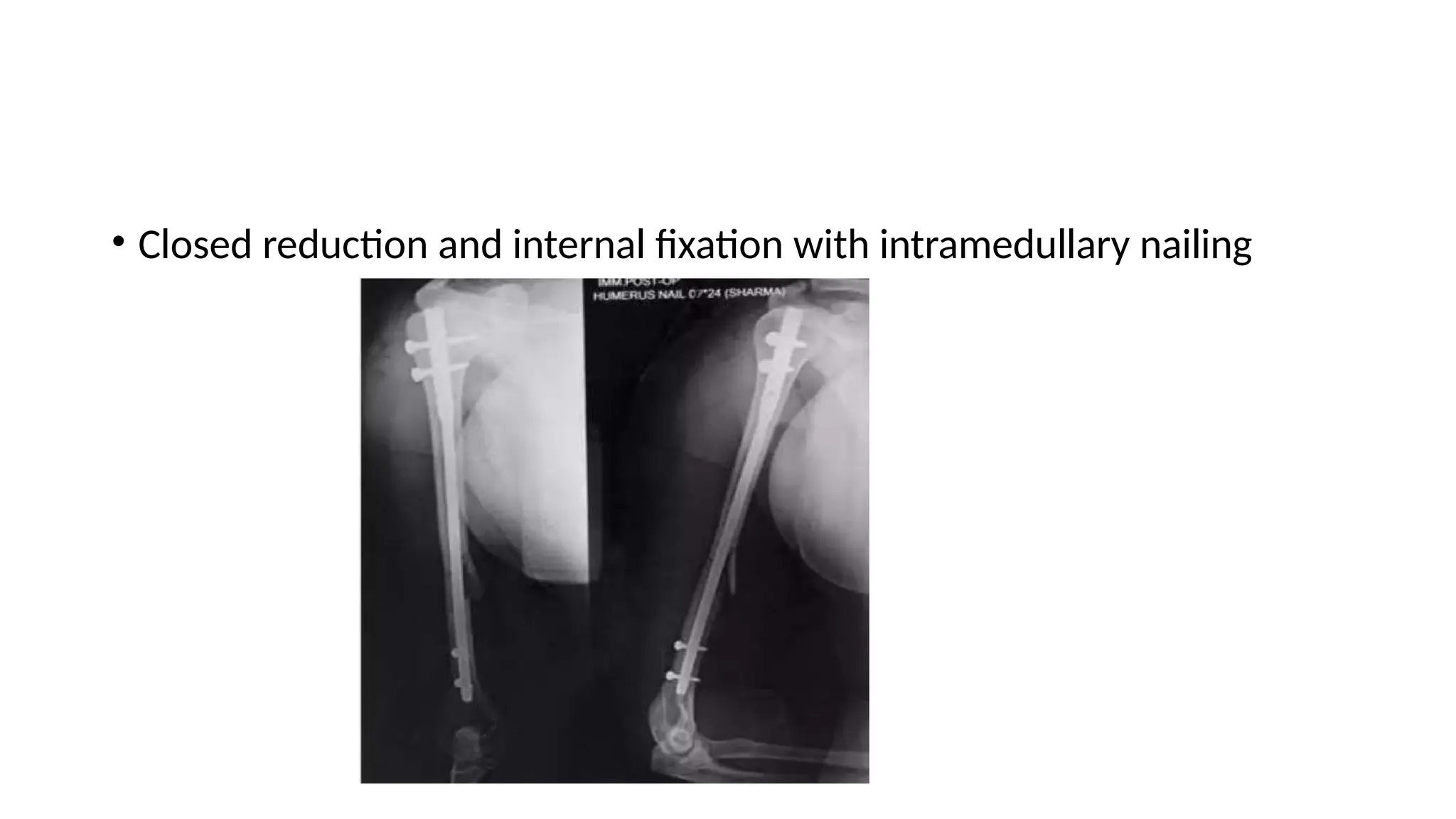 fracture of humerus shaft and intercondylar fracture.pptx
