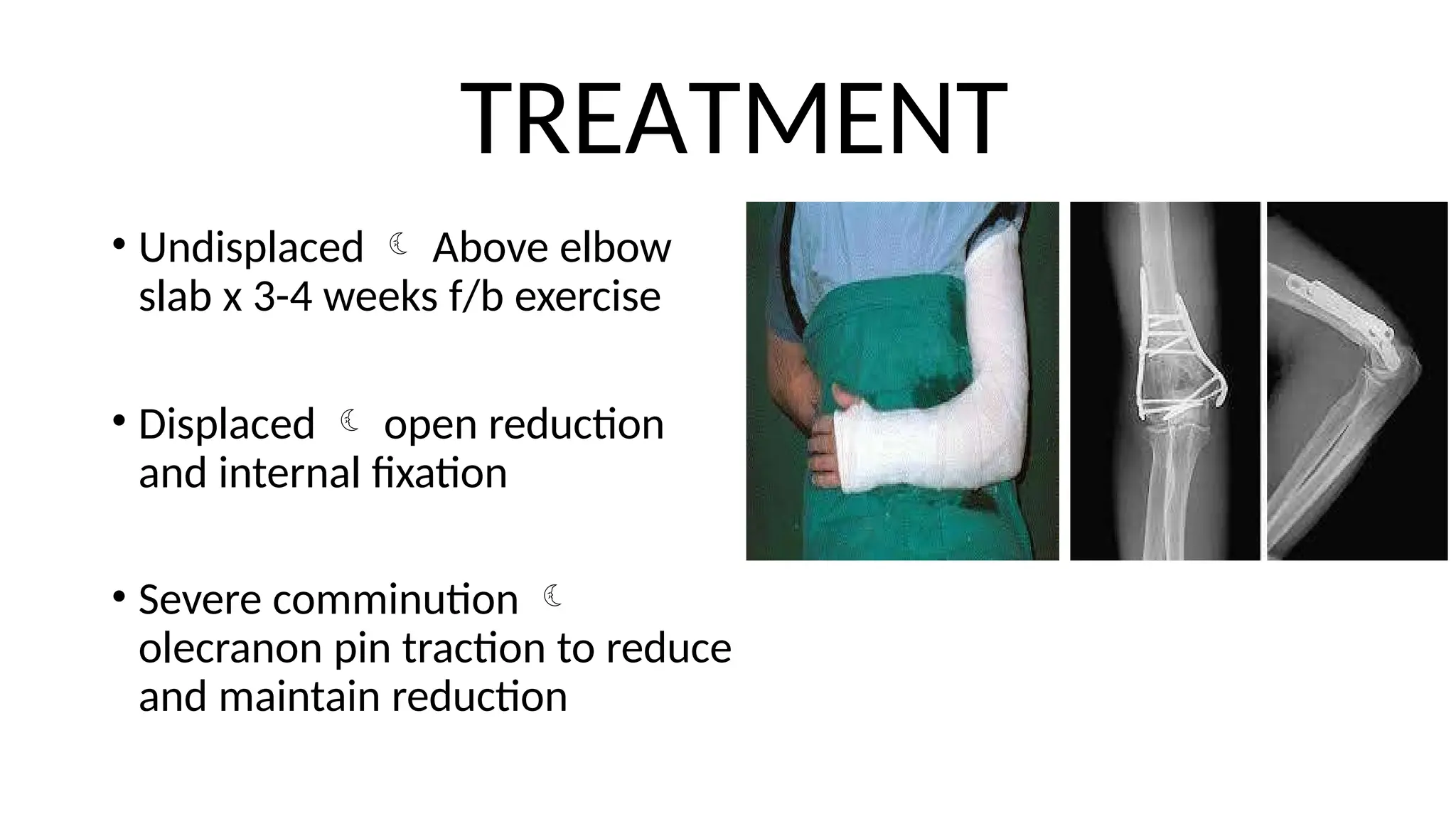 fracture of humerus shaft and intercondylar fracture.pptx