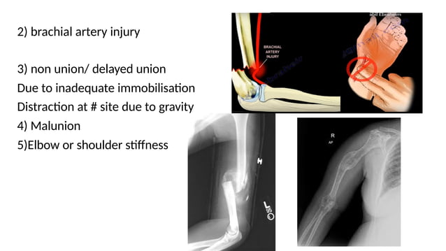 fracture of humerus shaft and intercondylar fracture.pptx