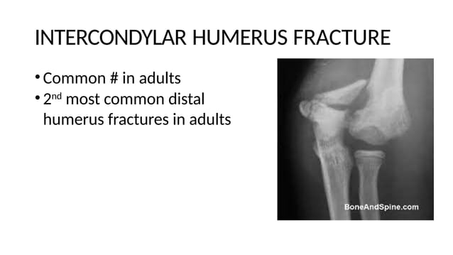fracture of humerus shaft and intercondylar fracture.pptx