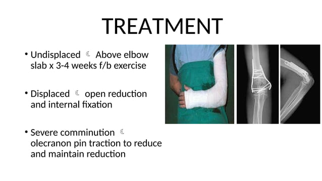 fracture of humerus shaft and intercondylar fracture.pptx