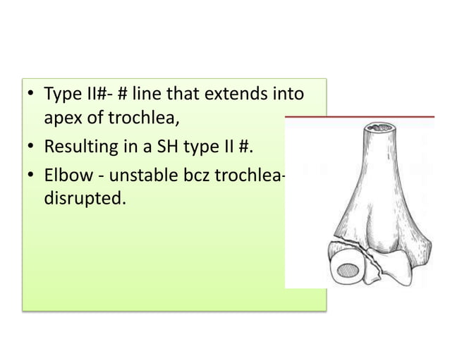 Fracture of lateral humeral condyle | PPTX | Death, Injury, or Military ...