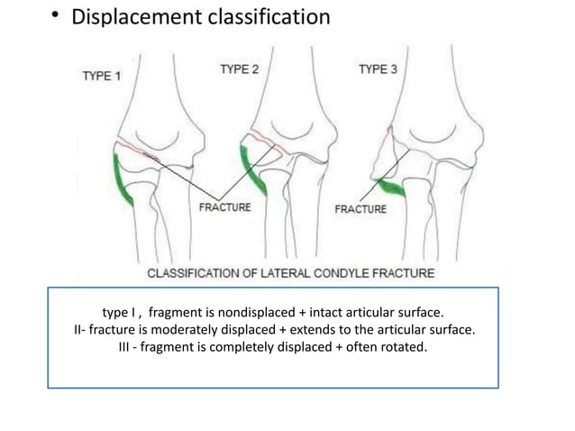 Fracture of lateral humeral condyle | PPTX | Death, Injury, or Military ...