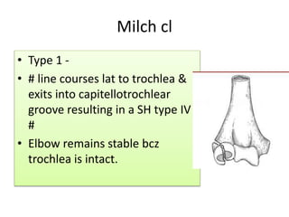 Fracture of lateral humeral condyle | PPTX
