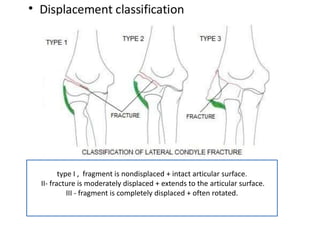 Lateral Condyle Humerus