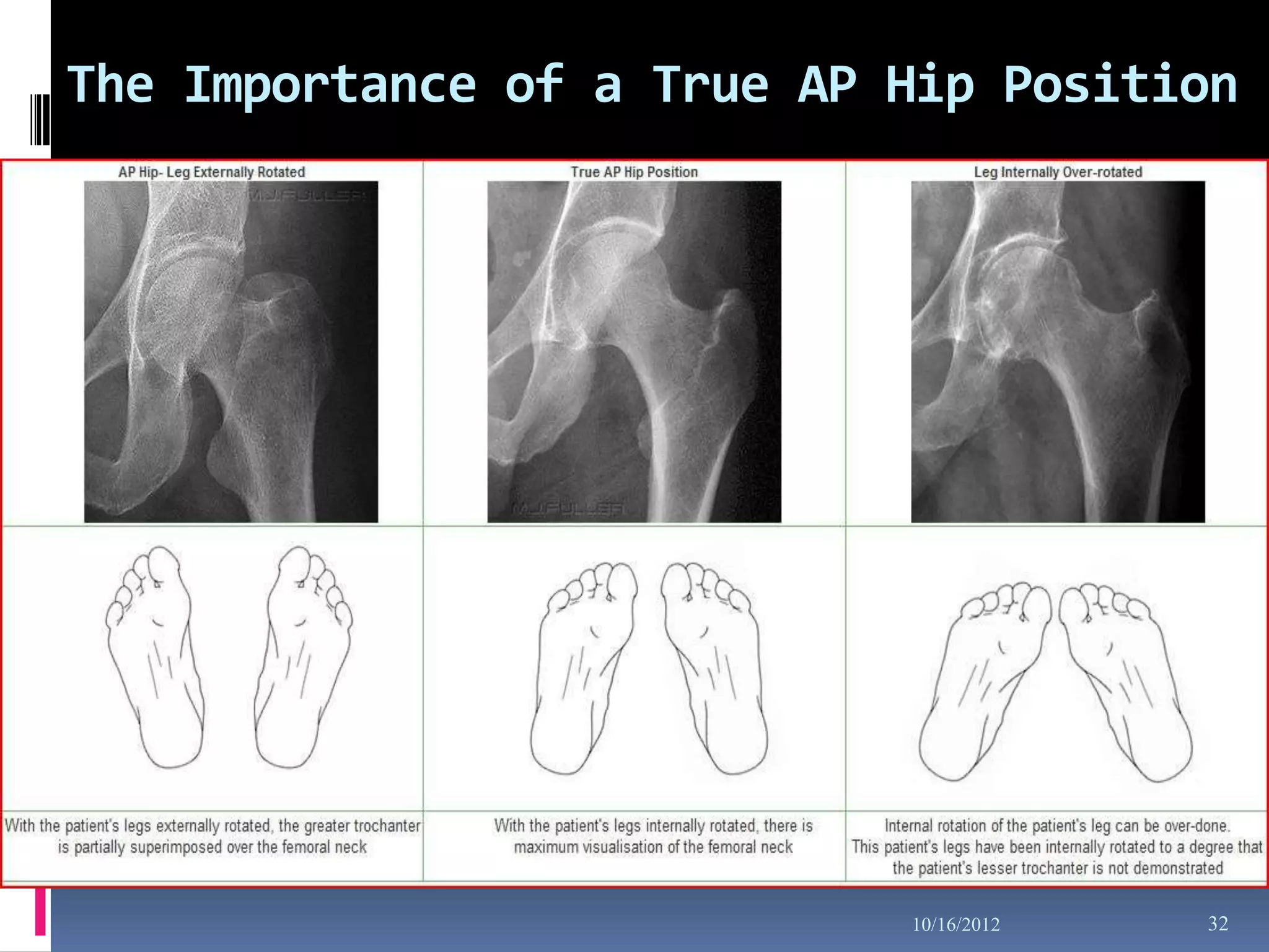 Fracture neck of femur | PPTX