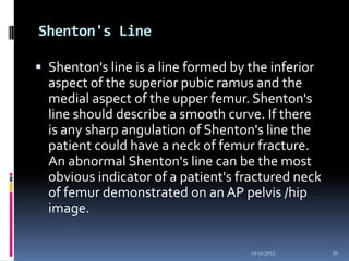 Fracture neck of femur | PPTX