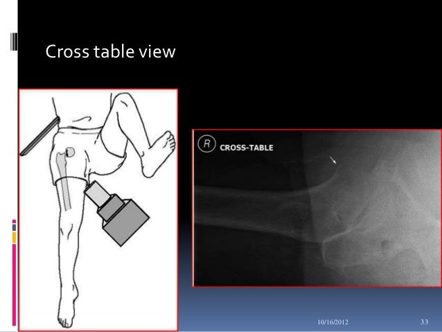 Fracture neck of femur
