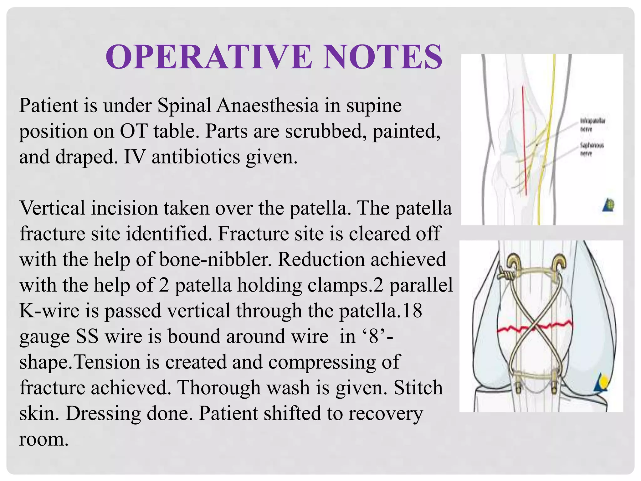 Fracture of patella | PPTX