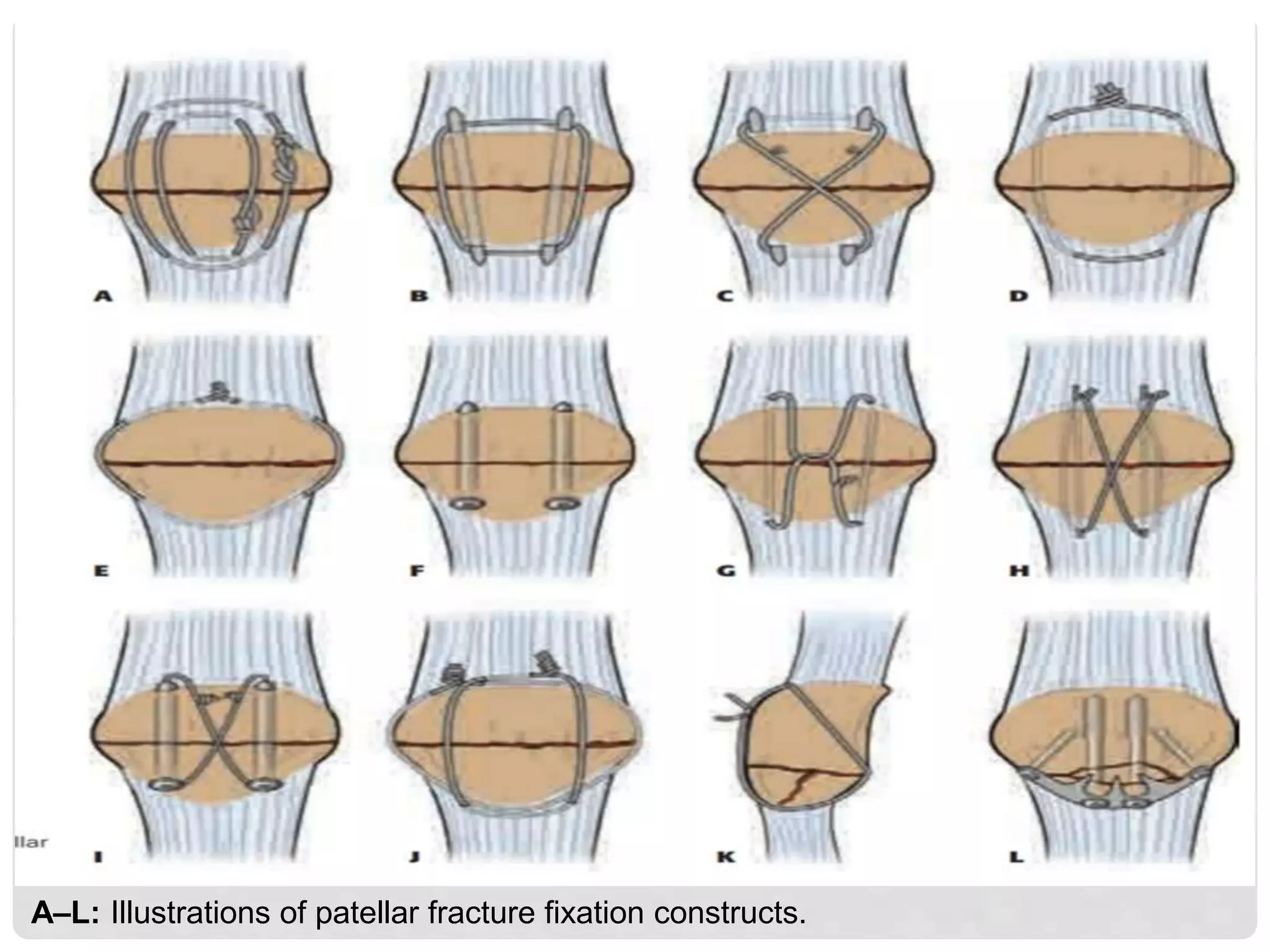 Fracture of patella | PPTX