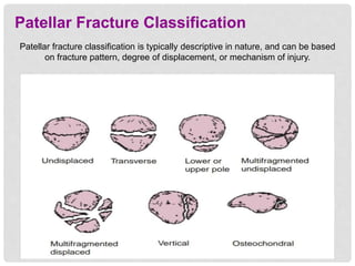 Patella Fracture Classification