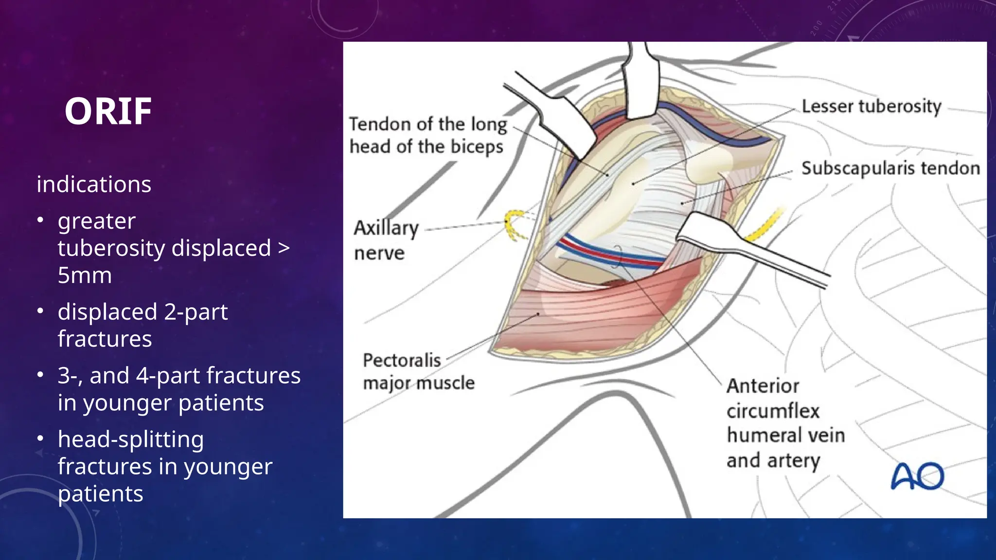 FRACTURE OF PROXIMAL HUMERUS- Etiopathogenesis , clinical features and ...