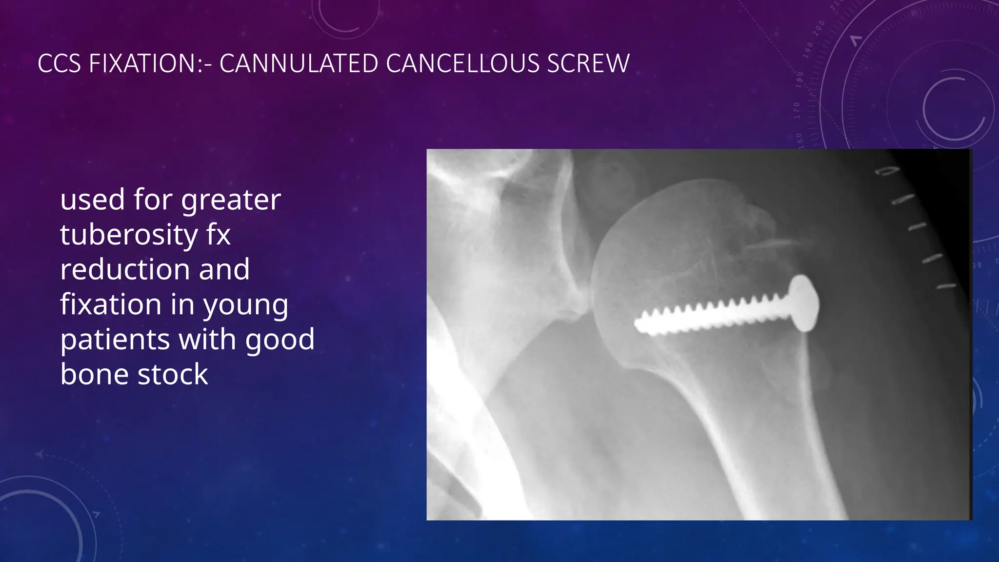 FRACTURE OF PROXIMAL HUMERUS- Etiopathogenesis , clinical features and ...