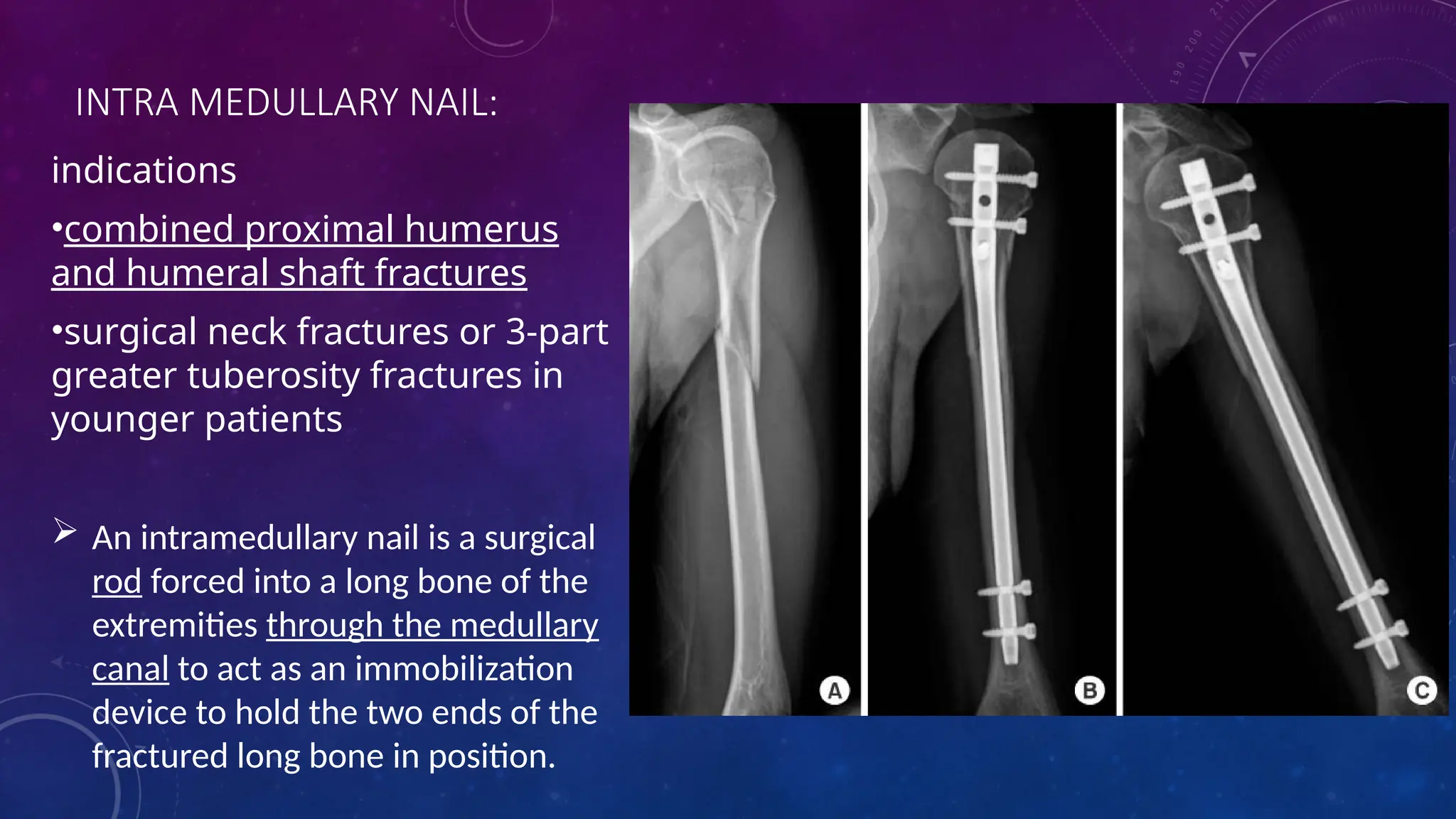 FRACTURE OF PROXIMAL HUMERUS- Etiopathogenesis , clinical features and management | PPTX