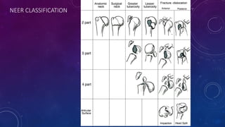 FRACTURE OF PROXIMAL HUMERUS- Etiopathogenesis , clinical features and ...
